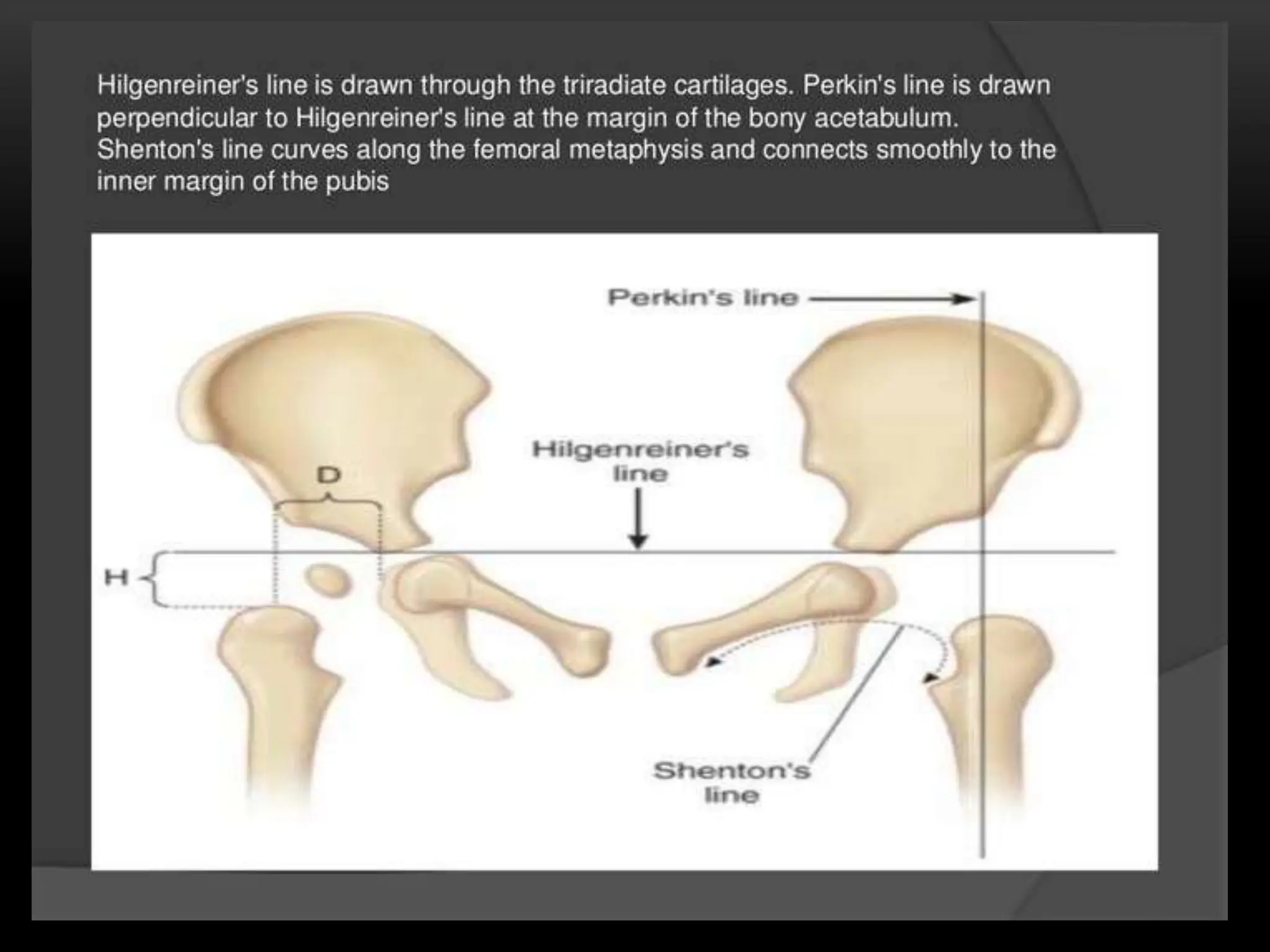 Developmental dysplasia of hip joint (DDH) | PPTX