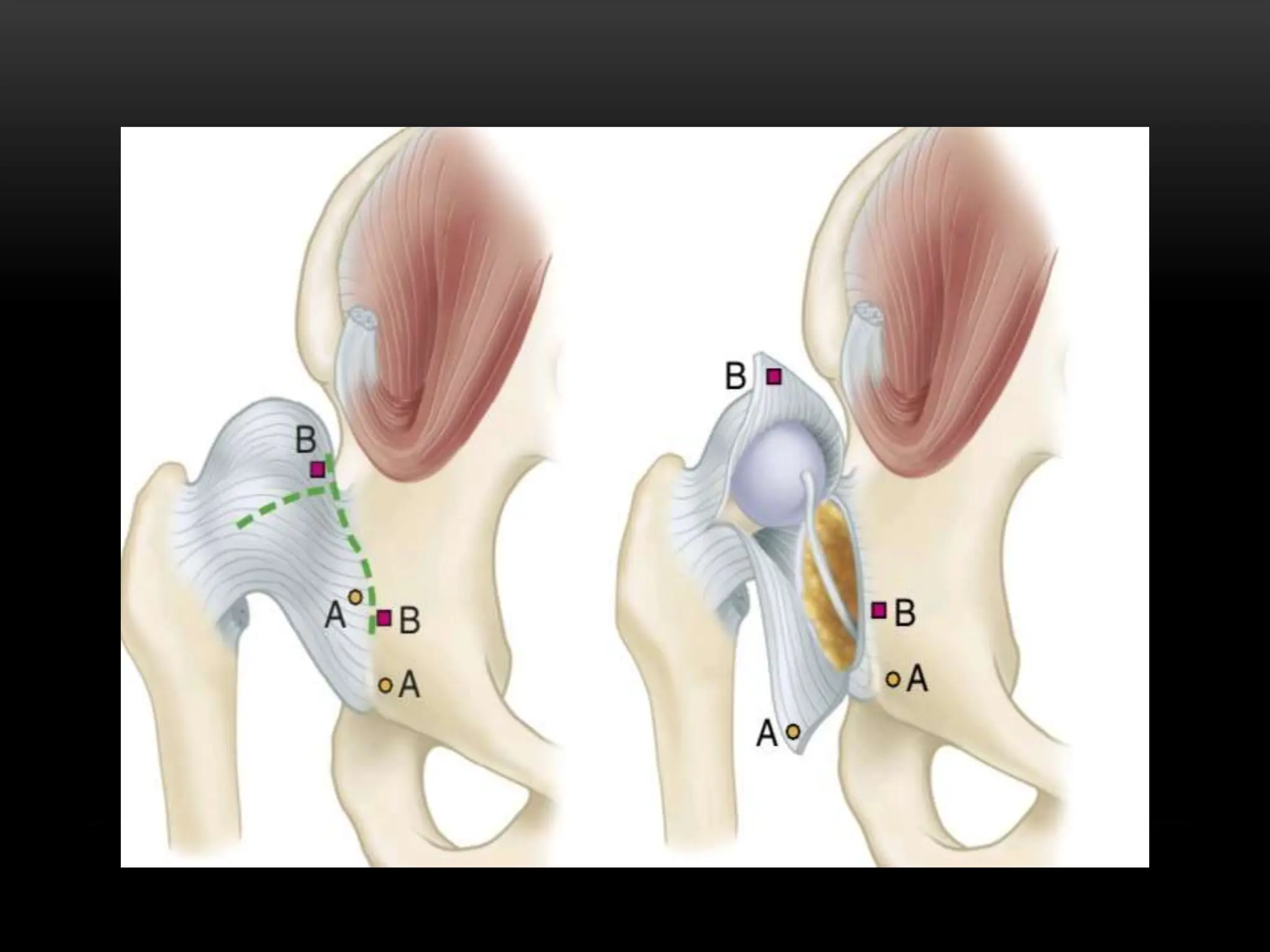 Developmental dysplasia of hip joint (DDH) | PPTX