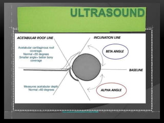 Developmental dysplasia of hip joint (DDH) | PPTX