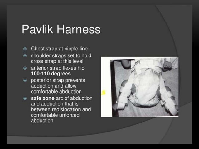 Developmental dysplasia of hip joint (DDH) | PPTX