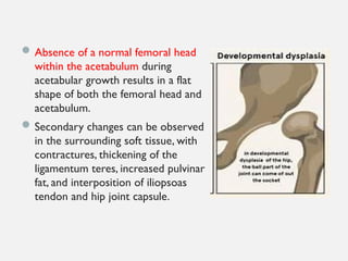 DEVELOPMENTAL DYSPLASIA OF HIP RADIOLOGY.pptx