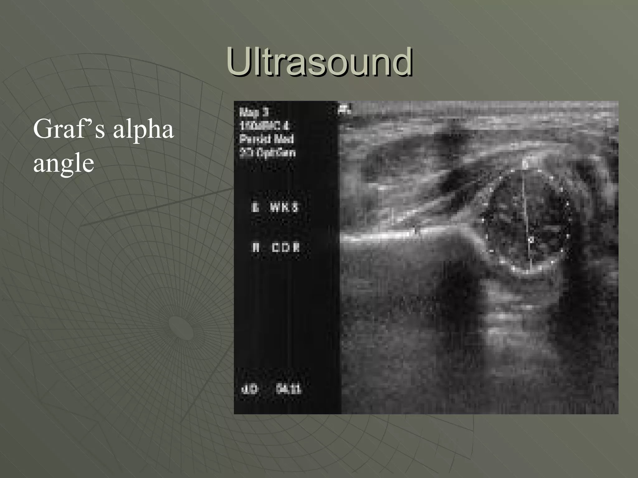 Developmental Dysplasia of the Hip and Ultrasound | PPT