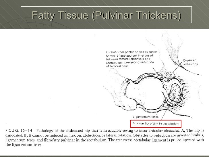 Developmental Dysplasia of the Hip and Ultrasound
