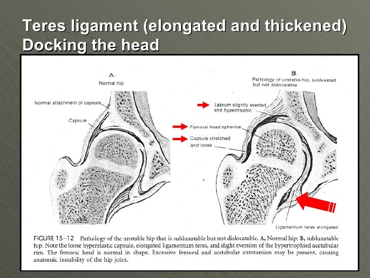 Developmental Dysplasia of the Hip and Ultrasound