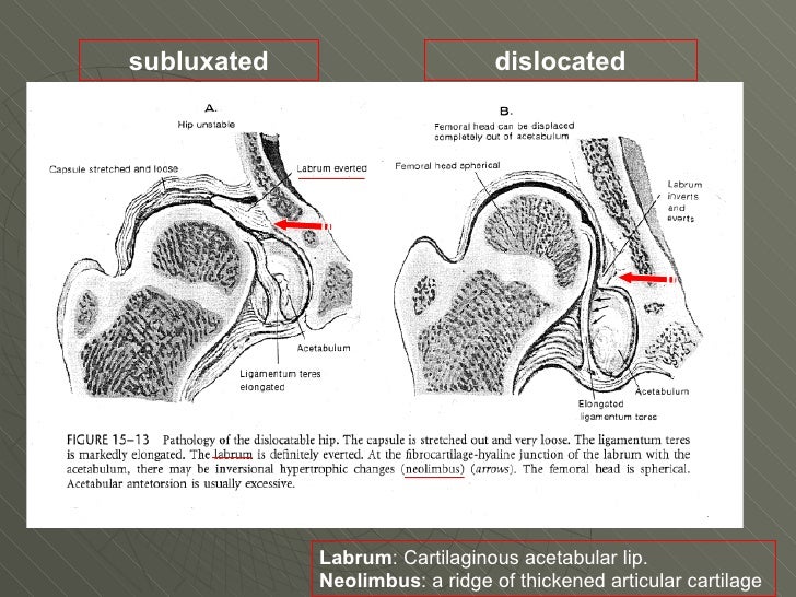Developmental Dysplasia of the Hip and Ultrasound