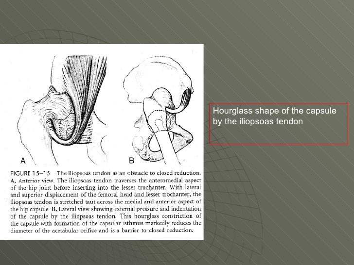 Developmental Dysplasia of the Hip and Ultrasound