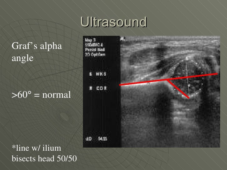 Developmental Dysplasia of the Hip and Ultrasound