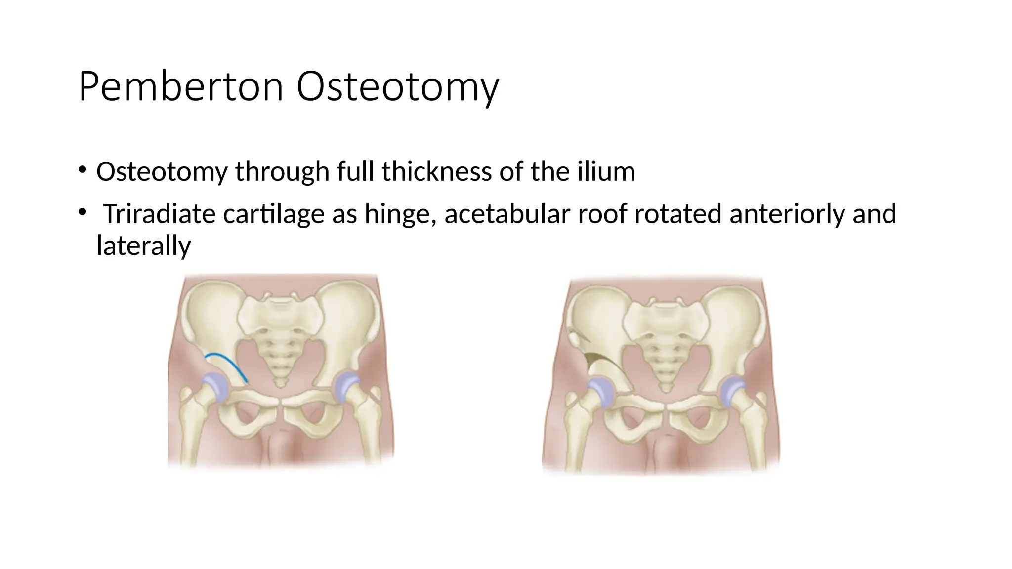 DDH Treatment Overview Paediatrics .pptx