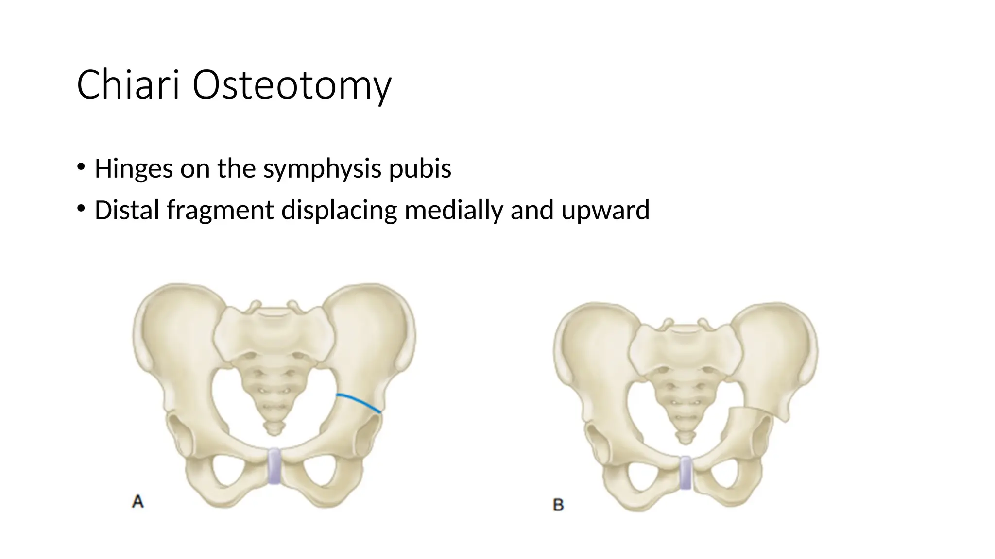 DDH Treatment Overview Paediatrics .pptx