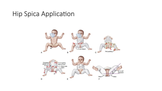 DDH Treatment Overview Paediatrics .pptx