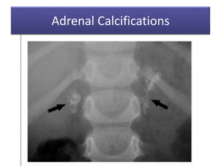 Peritoneum , Intraperitoneal Spaces | PPTX