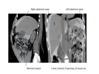 Peritoneum , Intraperitoneal Spaces | PPTX