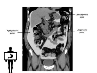 Peritoneum , Intraperitoneal Spaces | PPTX
