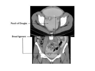 Peritoneum , Intraperitoneal Spaces | PPTX