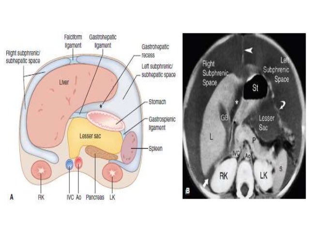 Peritoneum , Intraperitoneal Spaces