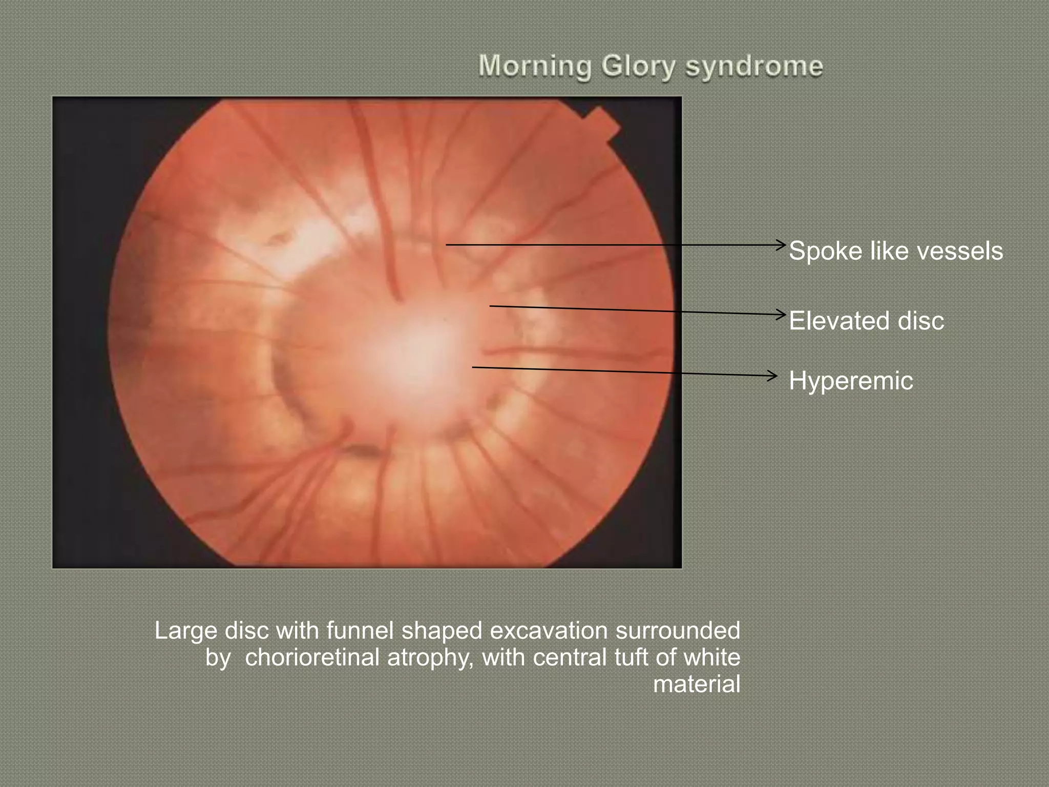 Dd of disc edema | PPTX
