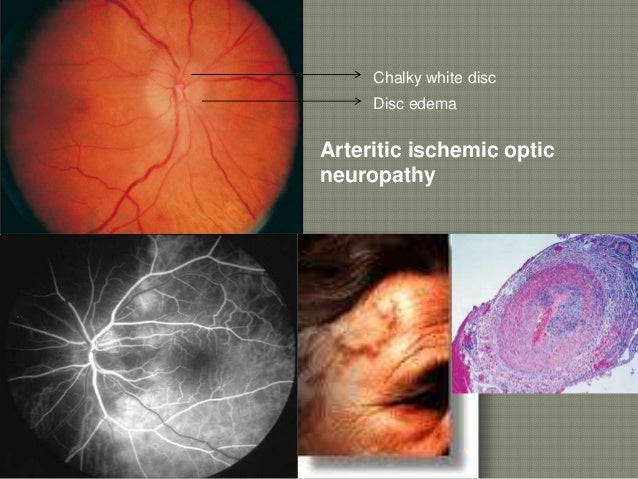 Differentiating Optic Disc Edema From Optic Nerve Head