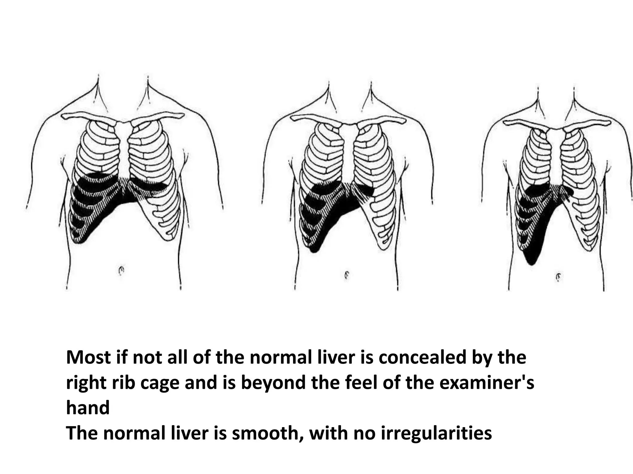 Differential Diagnosis of Hepatomegaly.pptx
