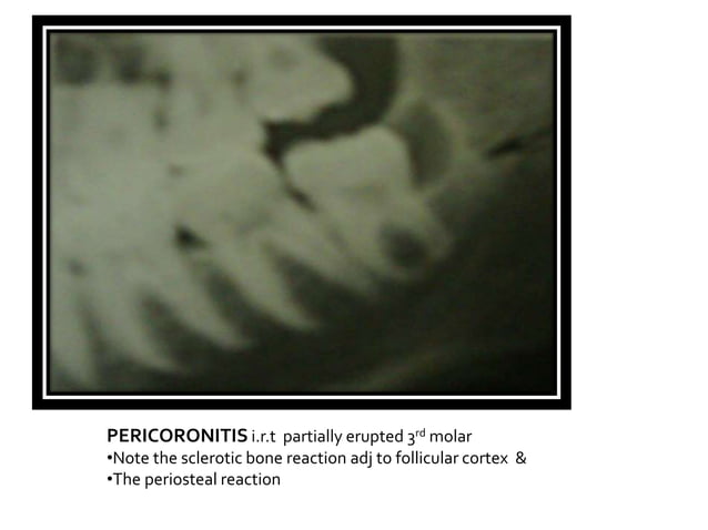 DD of pericoronal RL.pptx | Dental Health | Diseases and Conditions