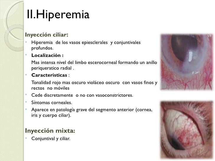 Hiperemia Conjuntival Qué Es, Causas, Síntomas Y Tratamiento – YOFR