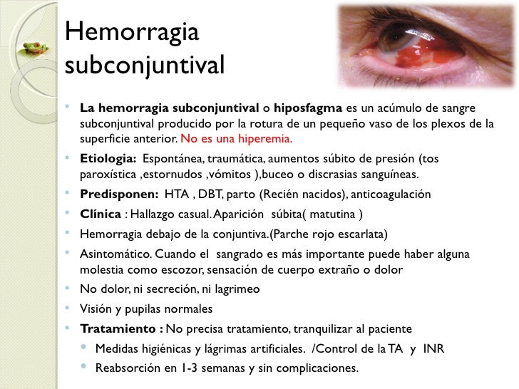 Hemorragia Subconjuntival