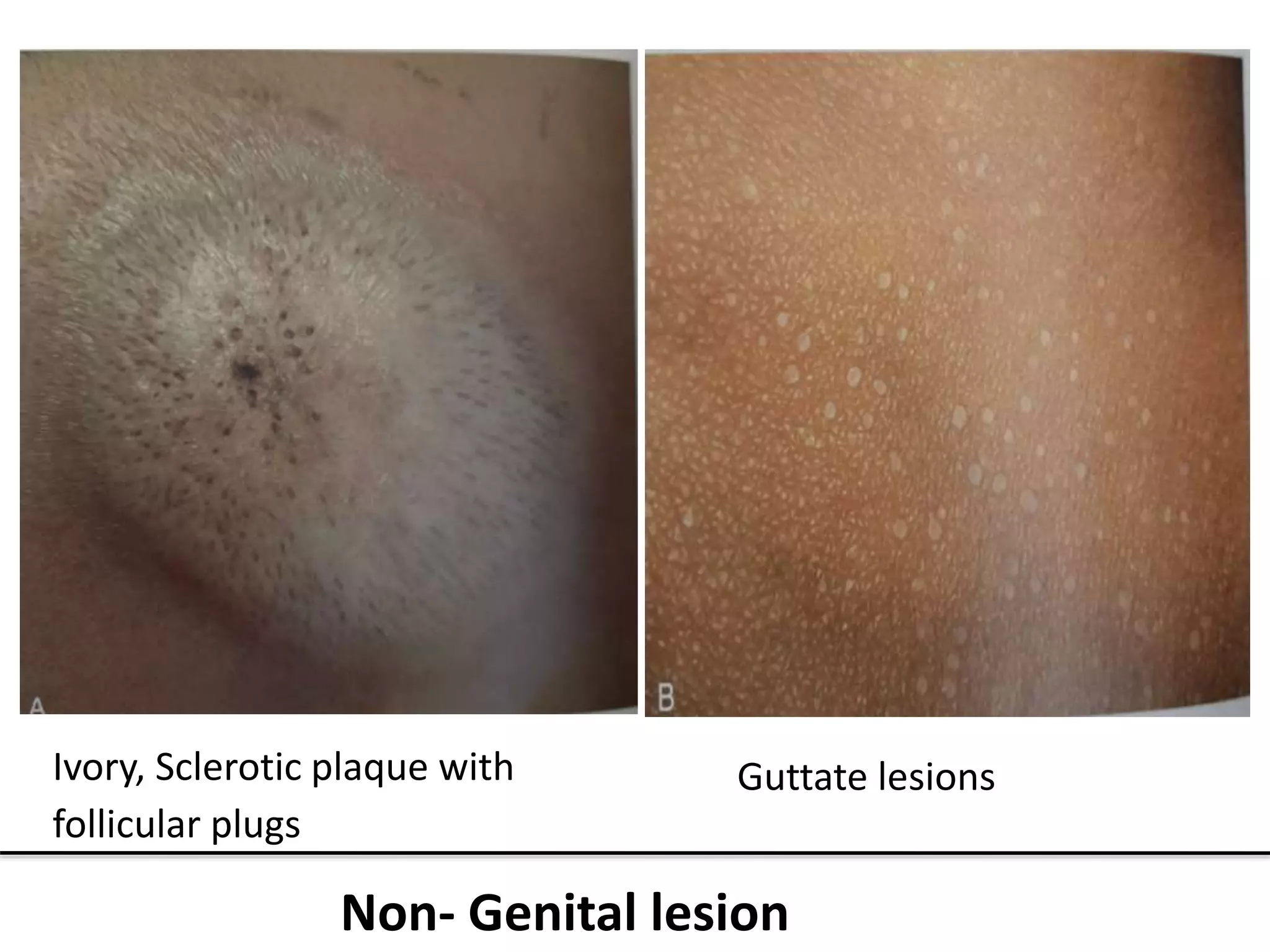 Lichen sclerosus.pptx