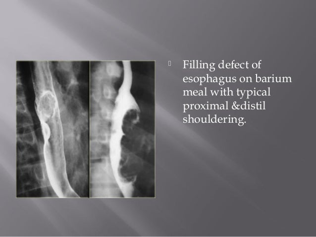 Dd’s of esophageal stricture and intra luminal filling defects