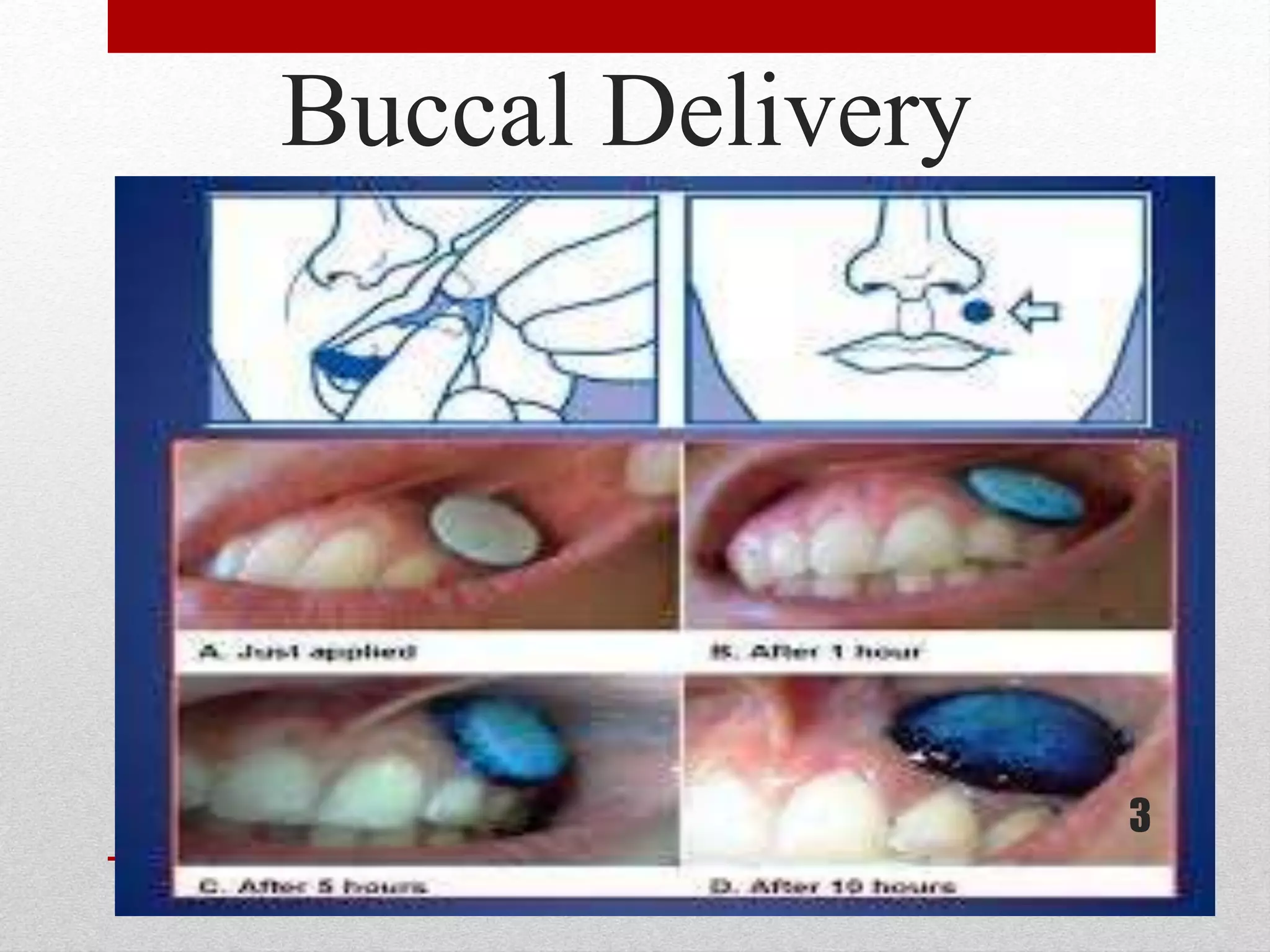 Buccal drug delivery system. | PPTX