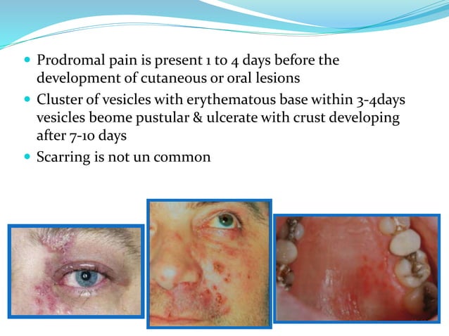 DD vesicular lesions.ppt