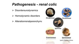 DDx ACUTE APPENDICITIS AND KIDNEY STONE.ru.en.pptx