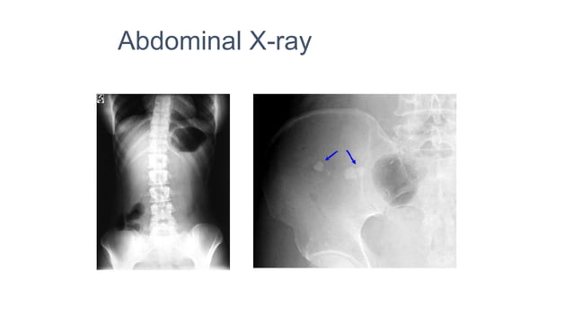 DDx ACUTE APPENDICITIS AND KIDNEY STONE.ru.en.pptx