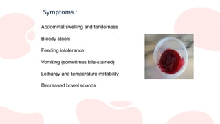 DDx of Bleeding Per Rectam for under graduate.pptx