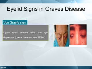 Differential Diagnosis of Proptosis | PPT