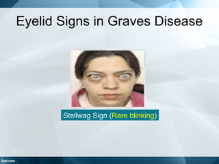 Differential Diagnosis of Proptosis | PPT