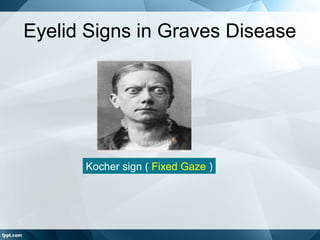 Differential Diagnosis of Proptosis | PPT