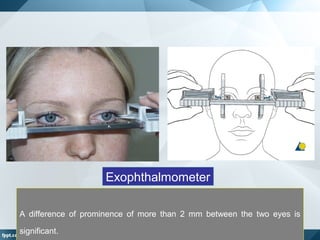 Differential Diagnosis of Proptosis | PPT