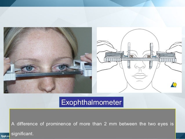 Differential Diagnosis of Proptosis