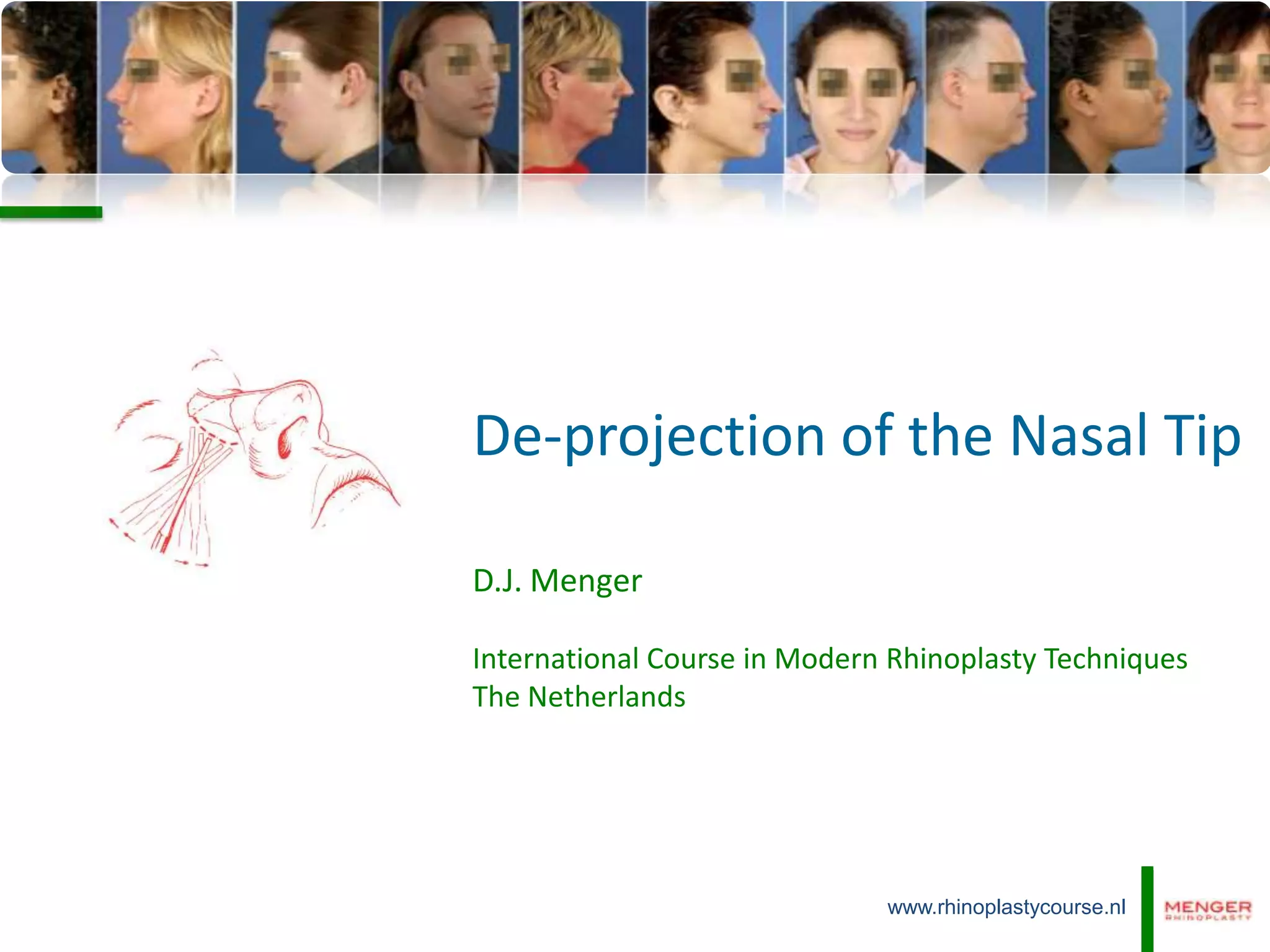 De-projection of the nasal tip | PPTX