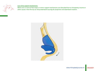 De-projection of the nasal tip | PPTX
