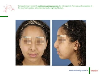 De-projection of the nasal tip | PPTX