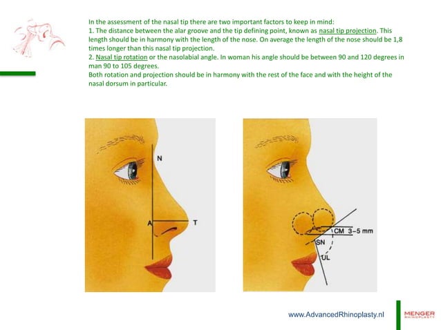 De-projection of the Nasal Tip | PPT