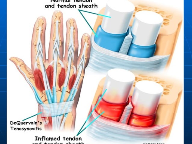 De Quervain’S Disease | PPT