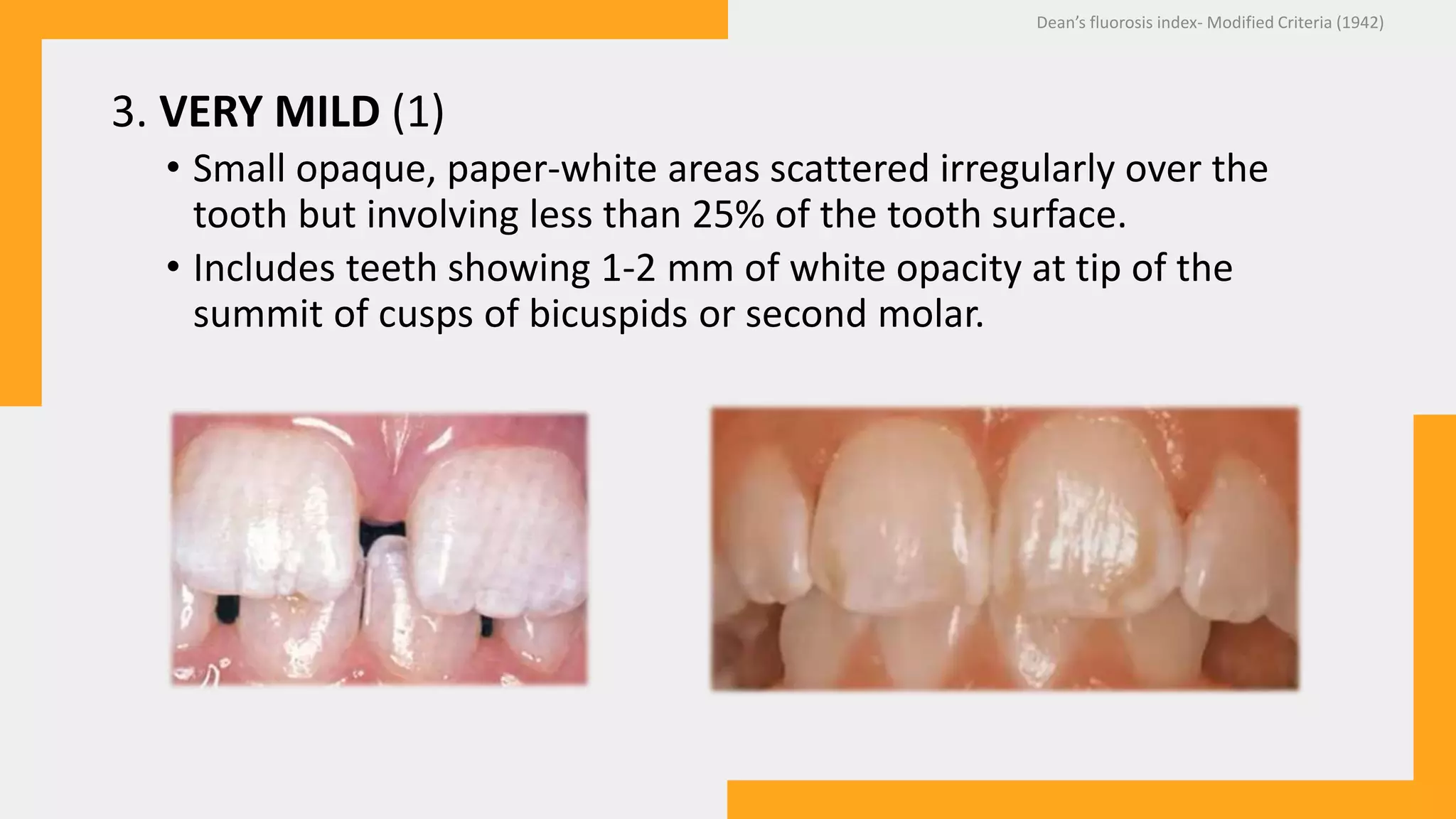DEAN’S FLUOROSIS INDEX 1943 (PUBLIC HEALTH DENTISTRY) | PPTX