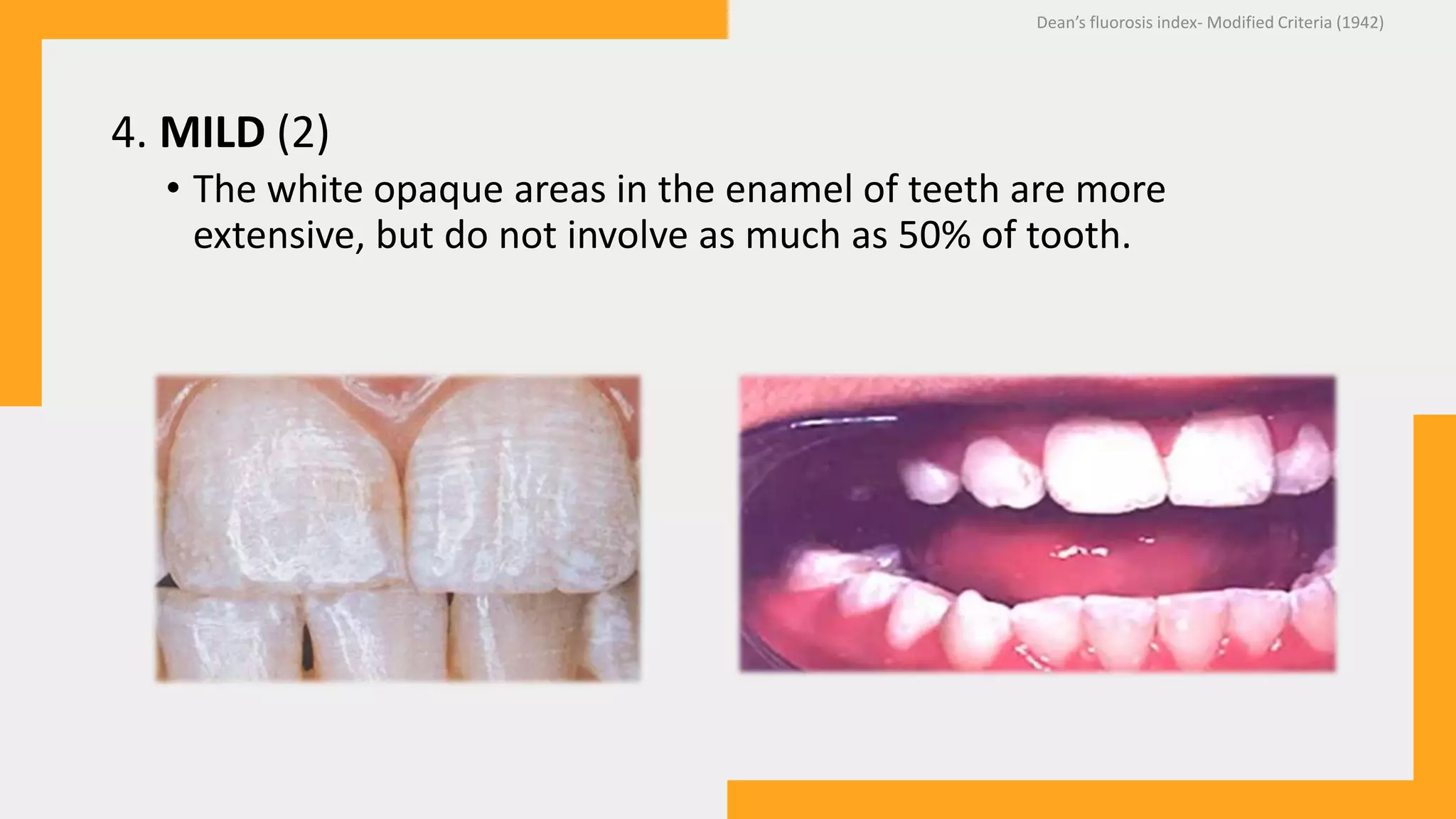 DEAN’S FLUOROSIS INDEX 1943 (PUBLIC HEALTH DENTISTRY) | PPTX