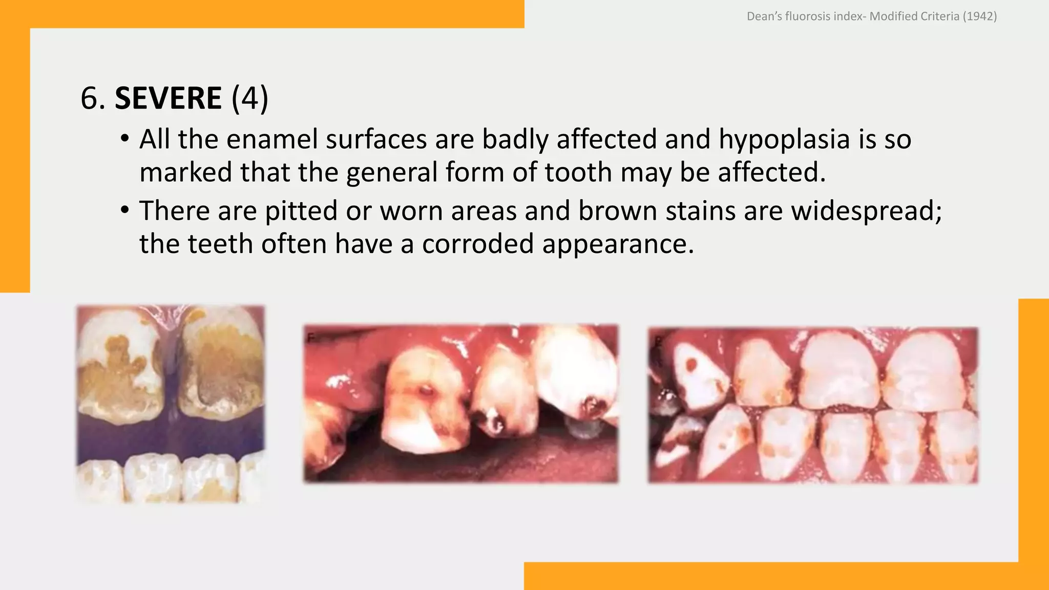 DEAN’S FLUOROSIS INDEX 1943 (PUBLIC HEALTH DENTISTRY) | PPTX