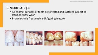 DEAN’S FLUOROSIS INDEX 1943 (PUBLIC HEALTH DENTISTRY) | PPTX