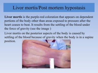 Livor Mortis