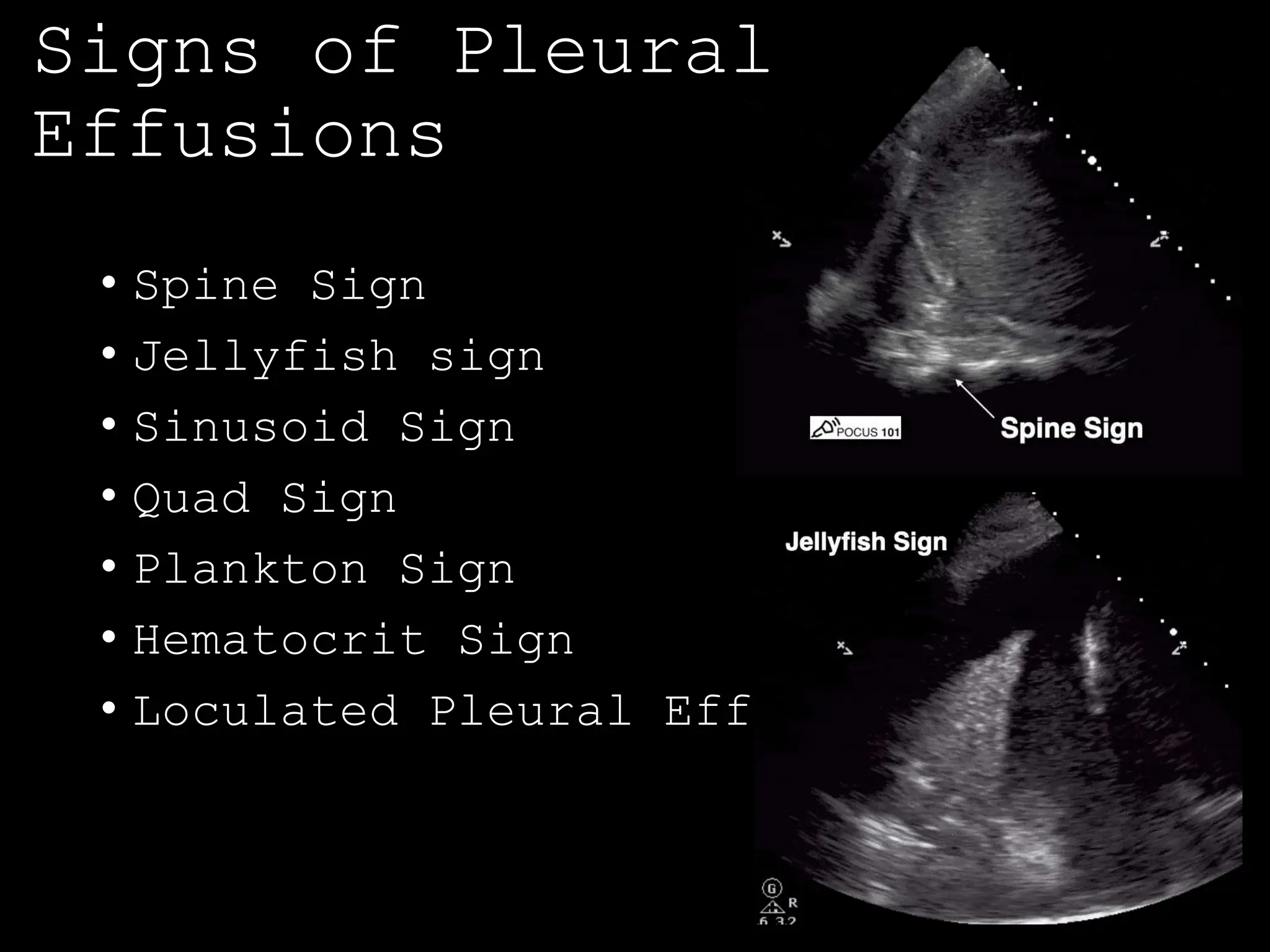 POCUS assessment of Dyspnea | PPTX