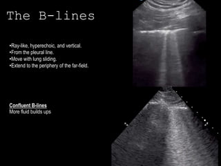 POCUS assessment of Dyspnea | PPT