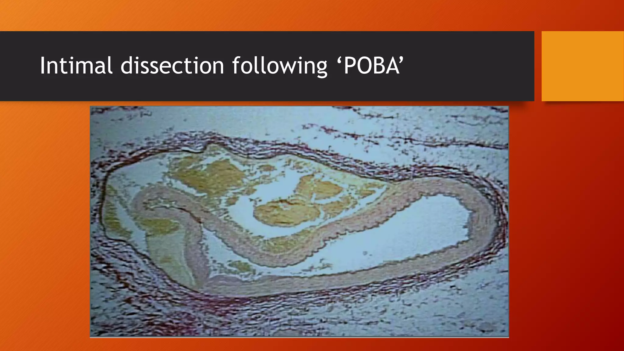 DRUG ELUTING BALLOONS (DCB/DEB) | PPTX